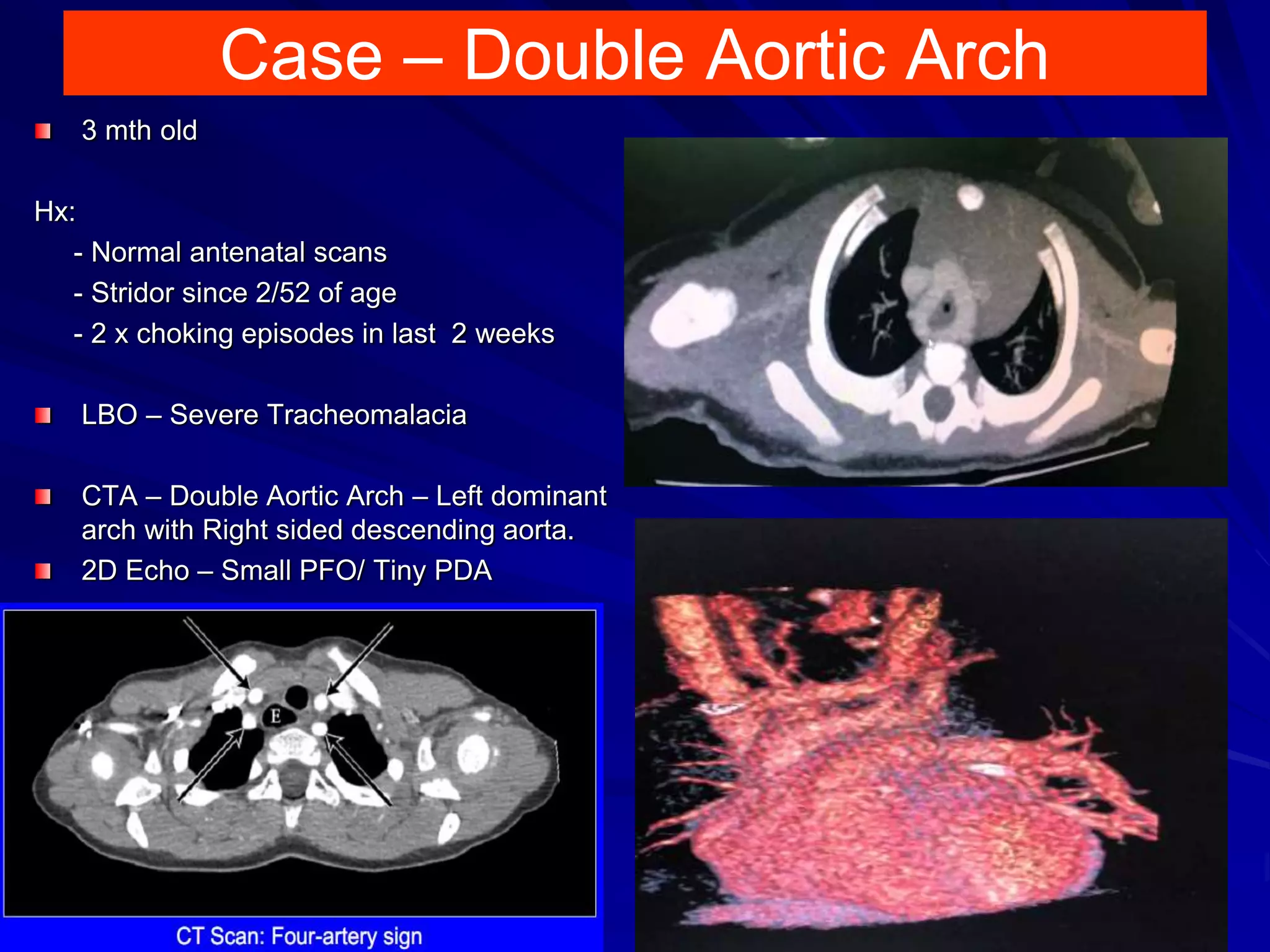 Vascular rings & slings | PPTX