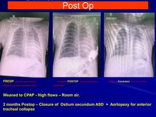 Vascular rings & slings | PPTX