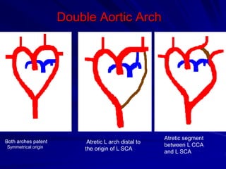 Vascular rings & slings | PPTX