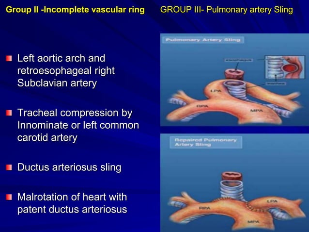 Vascular rings & slings | PPTX