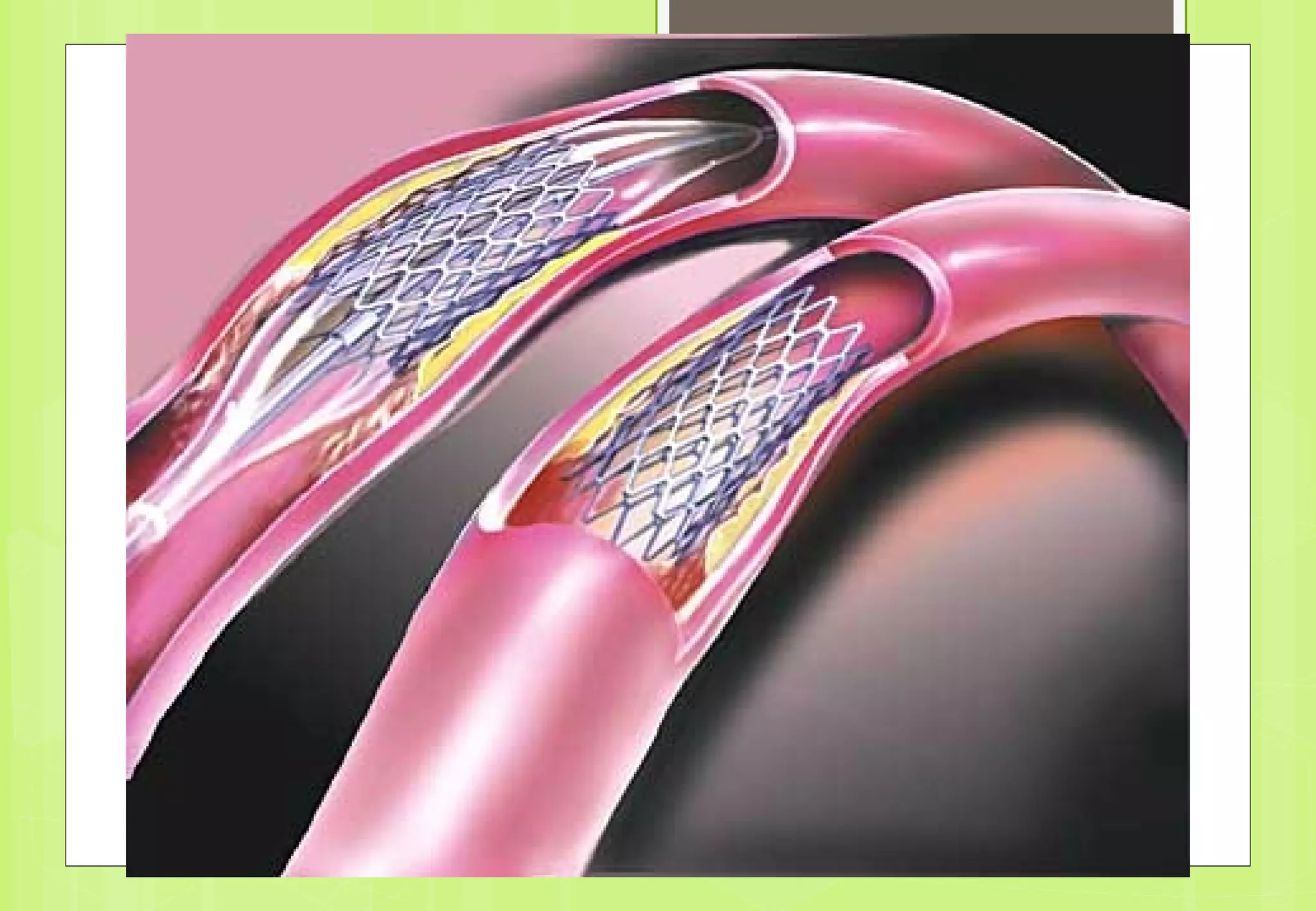 Vascular stents | PPT