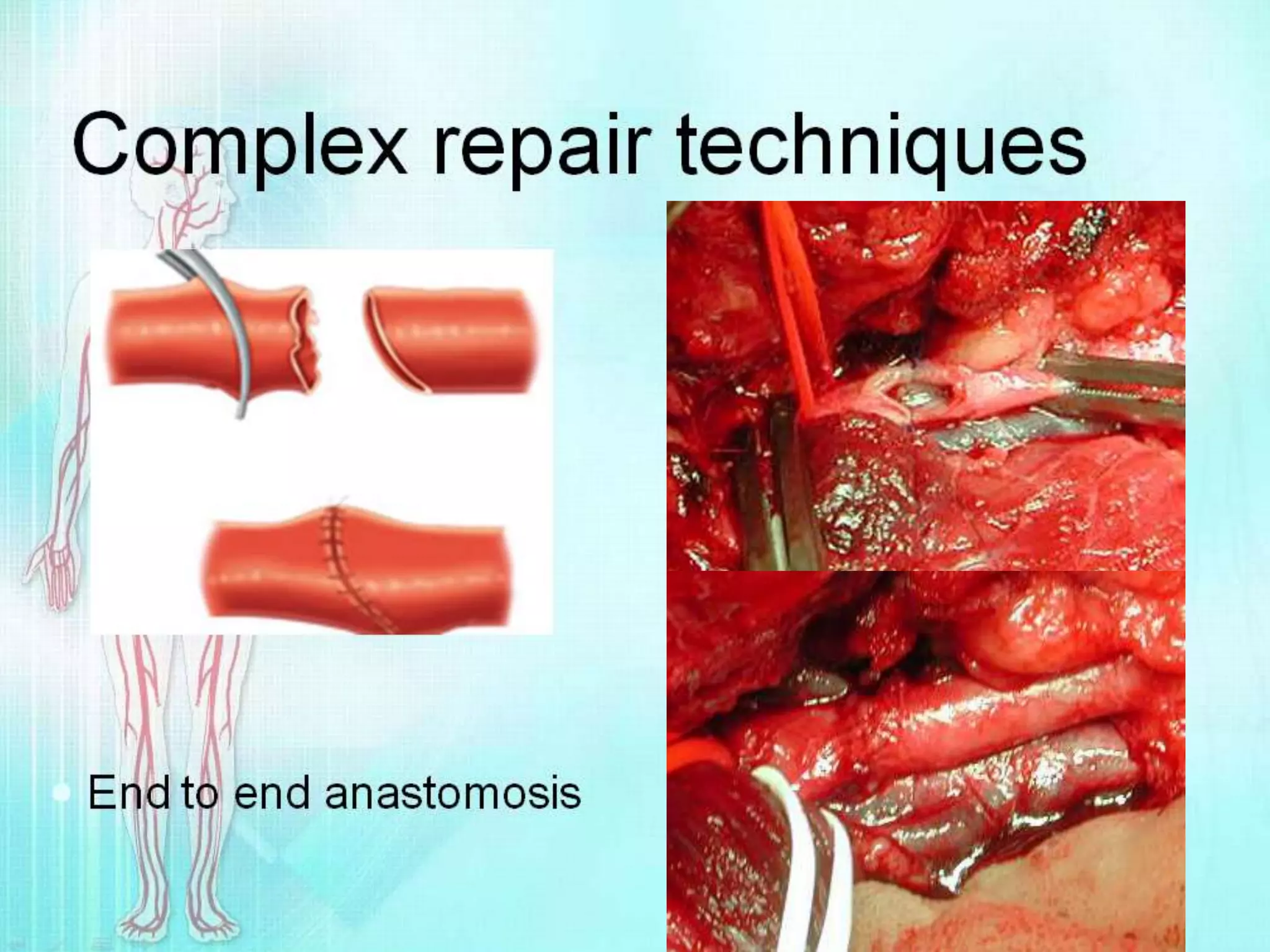 Vascular Trauma.pptx