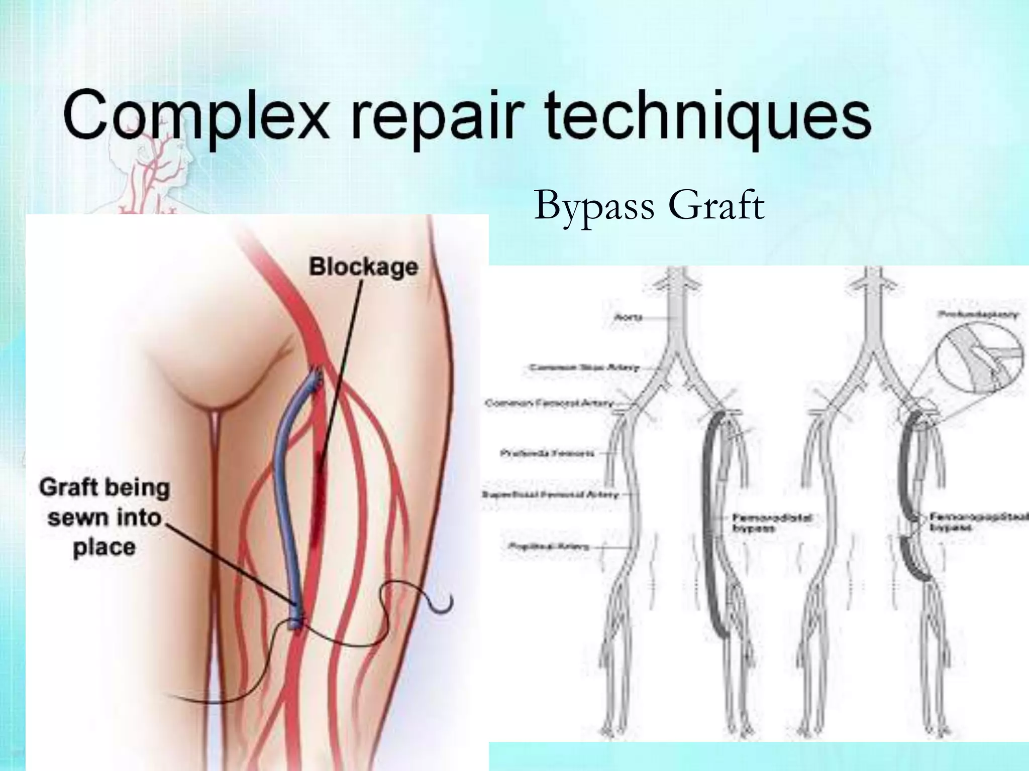 Vascular Trauma.pptx