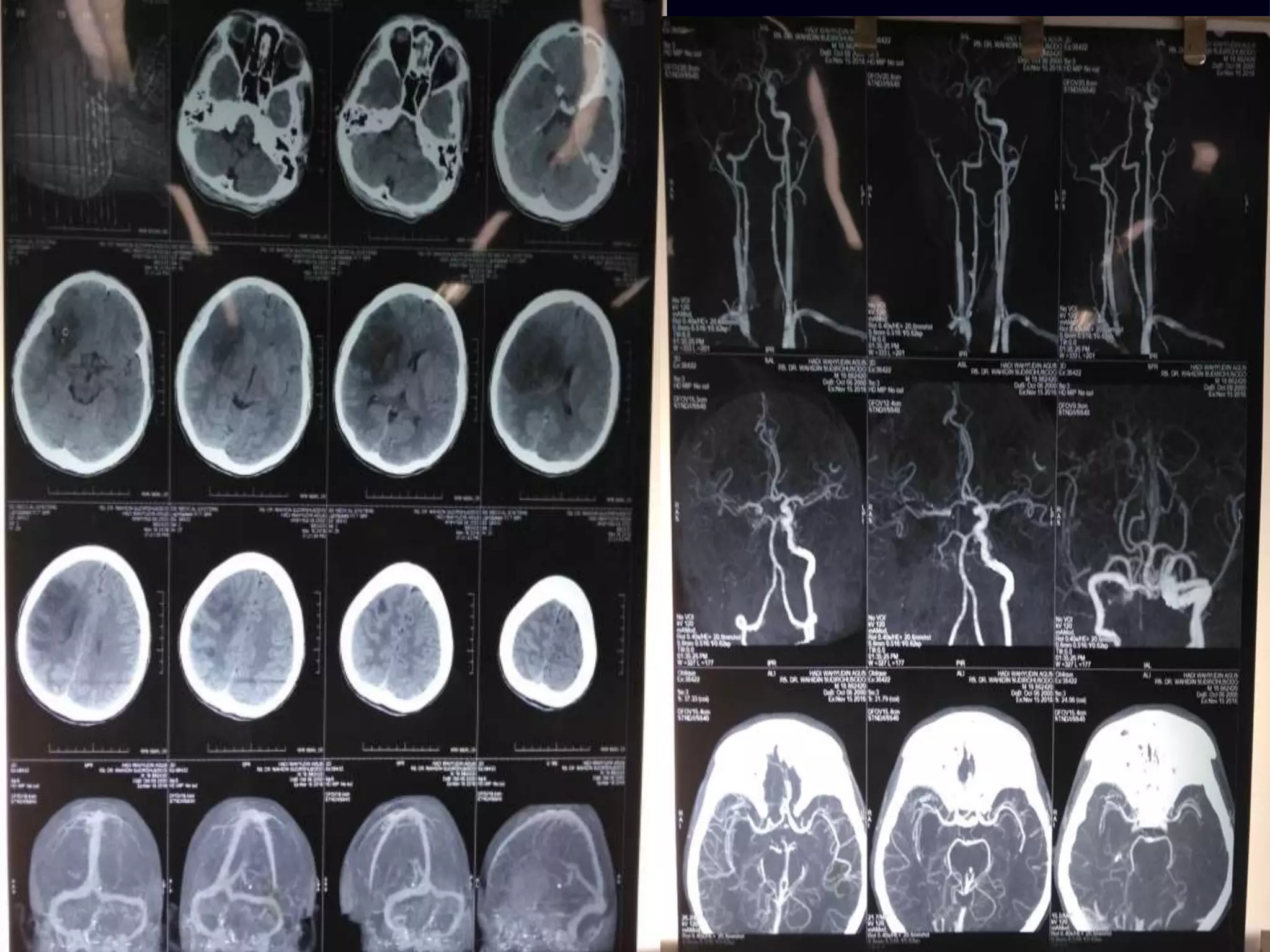 Vascular Trauma.pptx