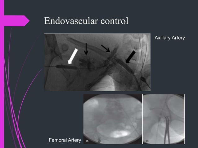 Lower extremity Vascular Trauma: Challenges & Pitfalls | PPT