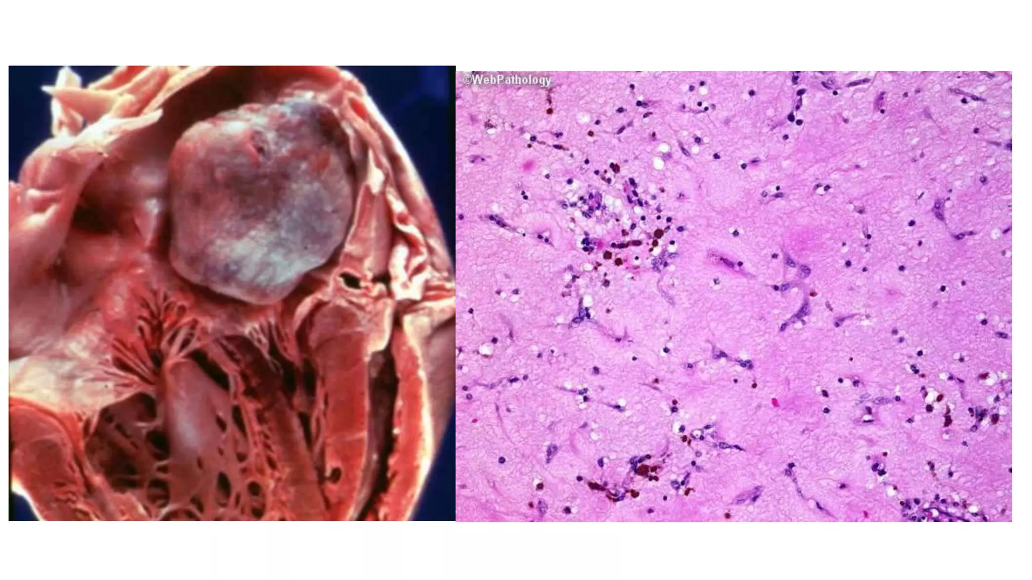 Vascular and Cardiac Tumors | PPT