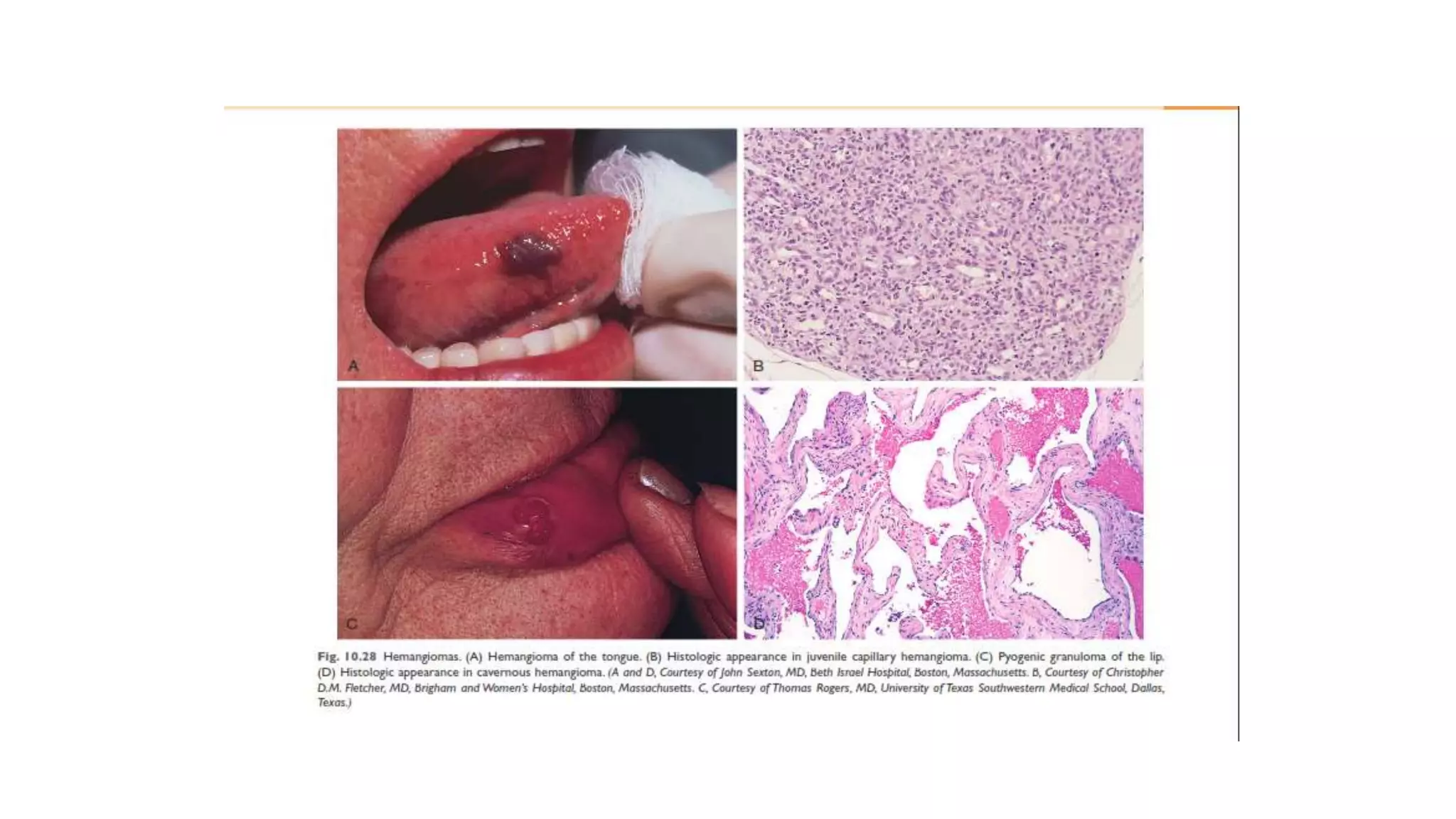 vascular tumors.pptx