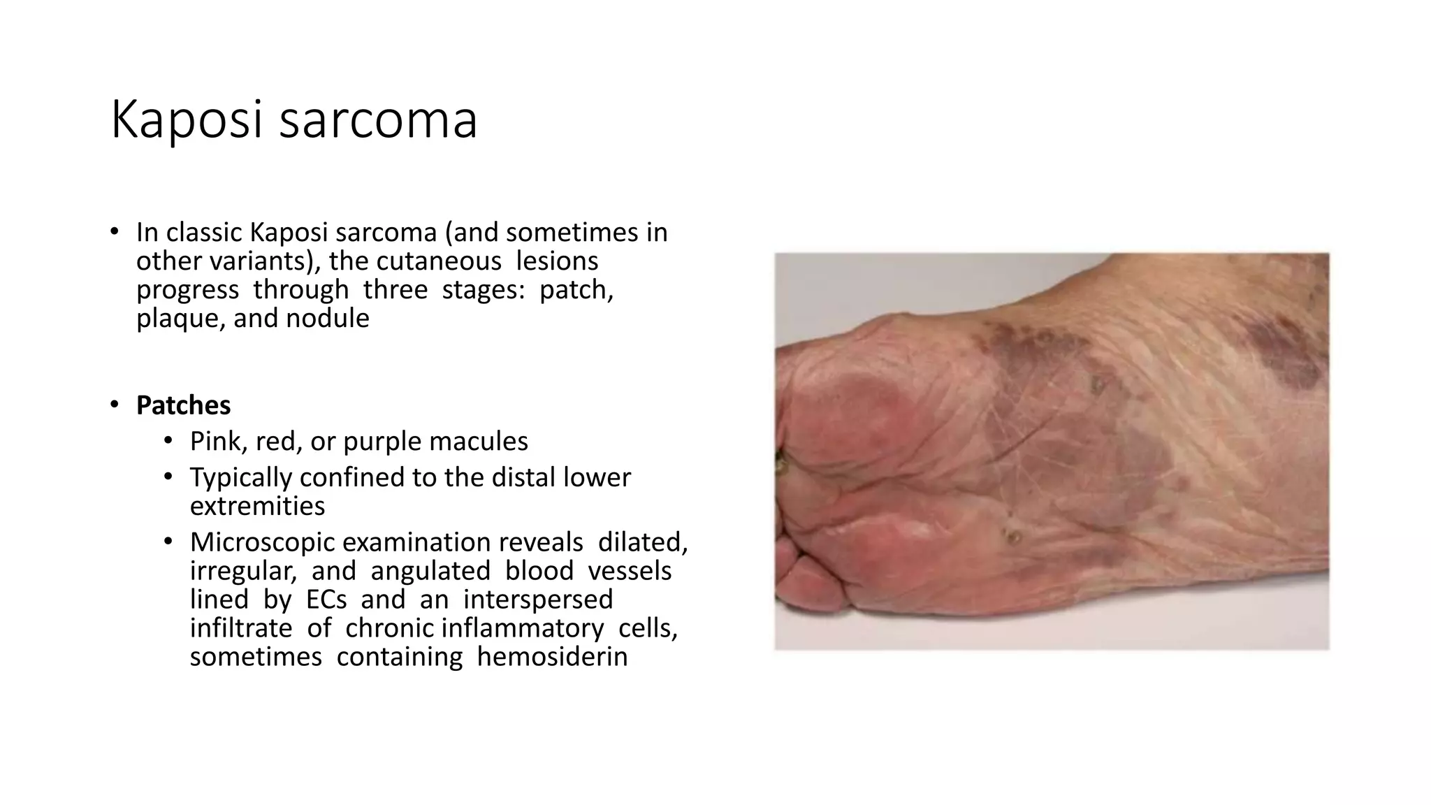 vascular tumors.pptx