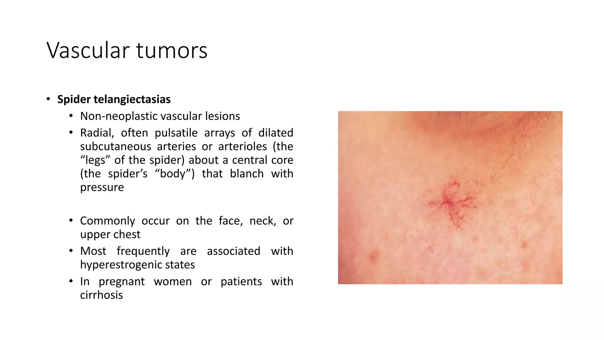 vascular tumors.pptx