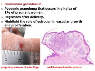 Vascular tumors 8 | PPTX