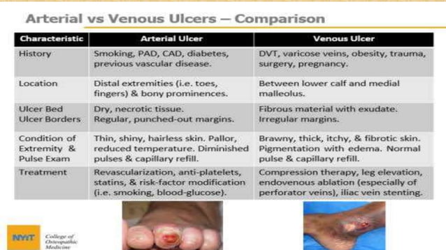 Vascular ulcer.pptx