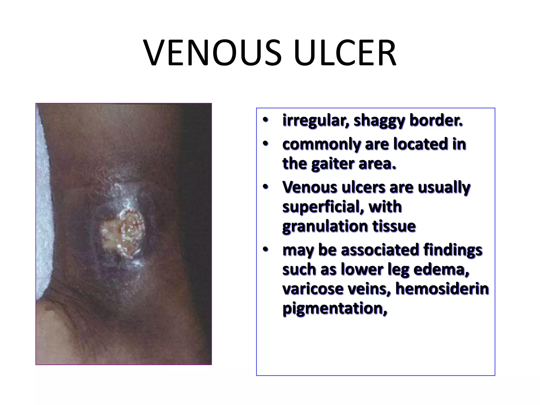 Vascular Ulcers Ppt - | PPTX