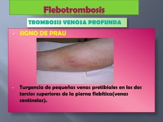 Vascular venoso periférico | PPTX