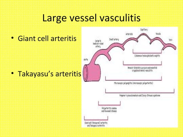 Vasculitis | PPT | Blood Disorders | Diseases and Conditions