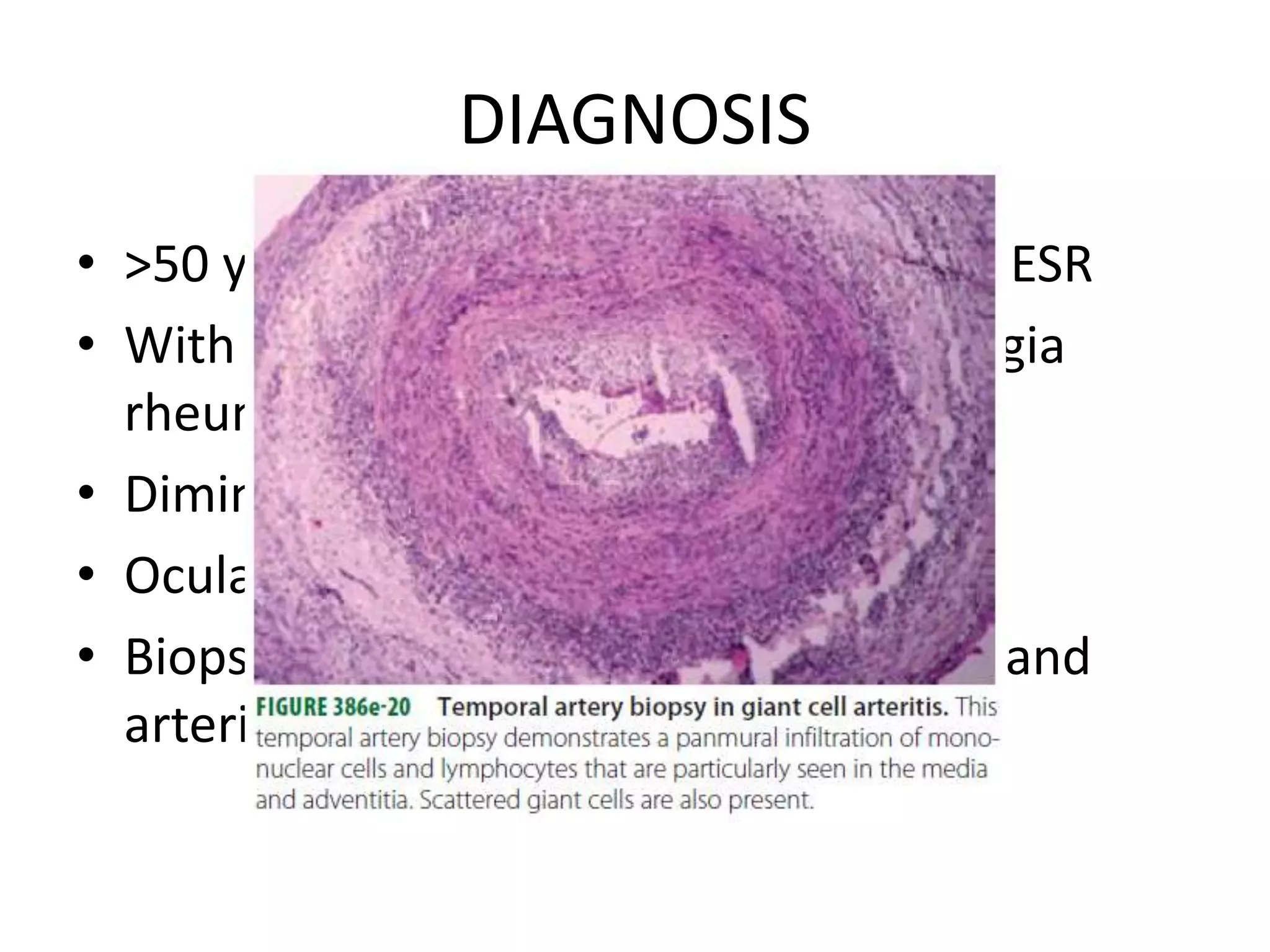 Vasculitis | PPTX