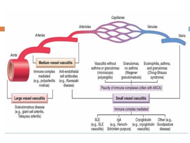 Vasculitis