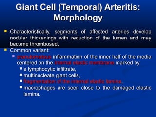Vasculitis | PPT