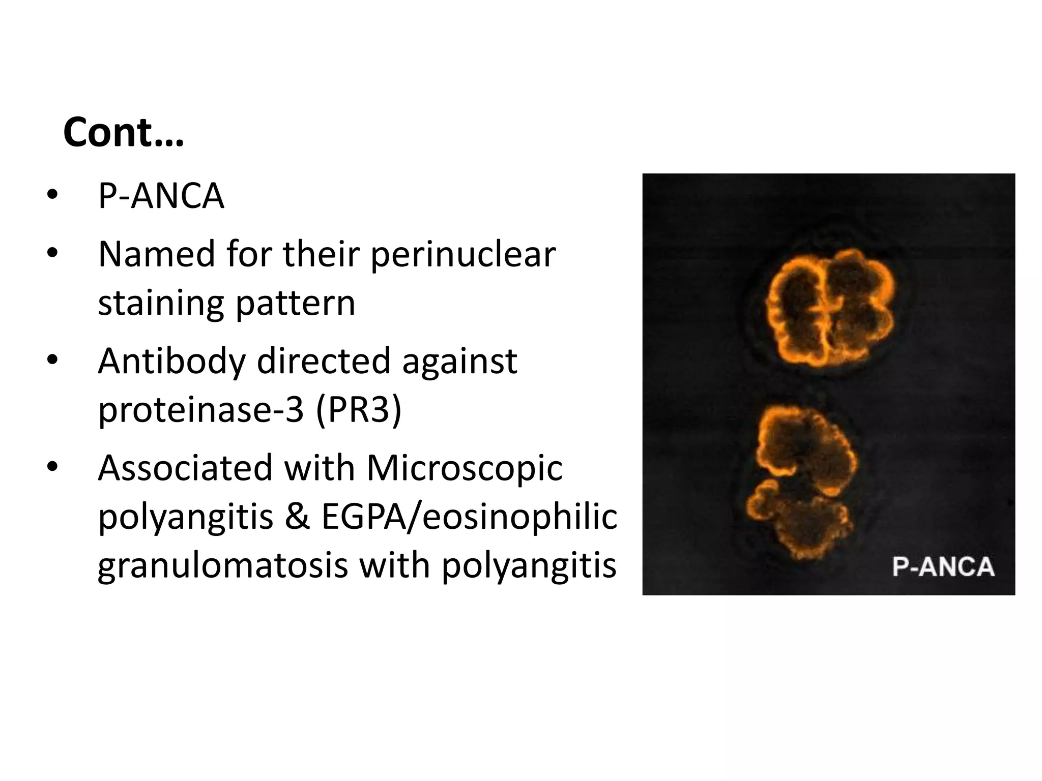 Small vessel vasculitis | PPTX