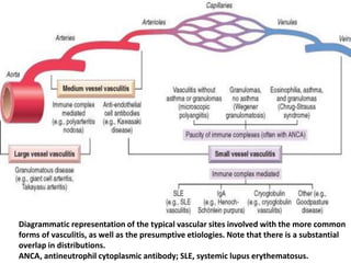 Vasculitis and varicose veins | PDF