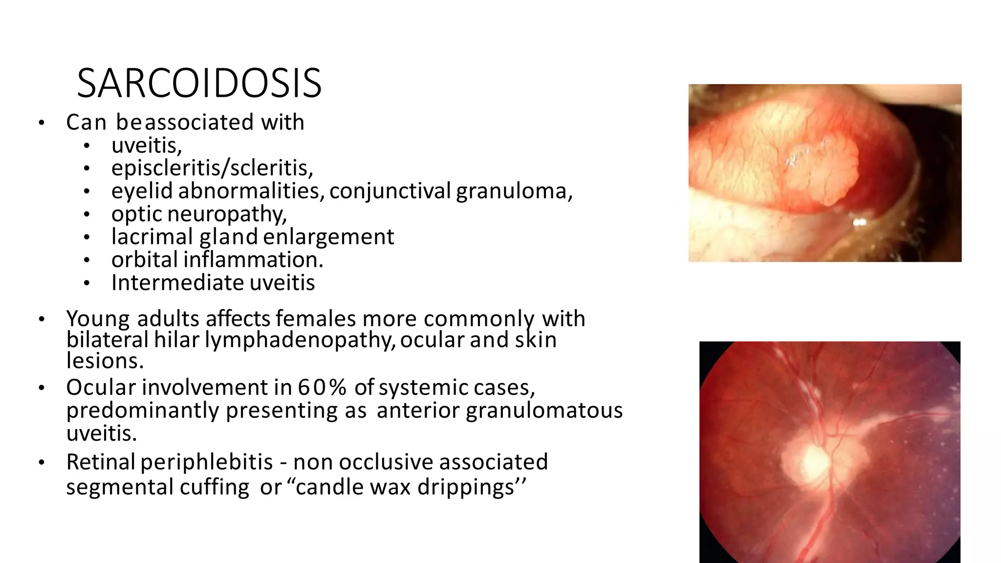 Retinal Vasculitis | PPTX