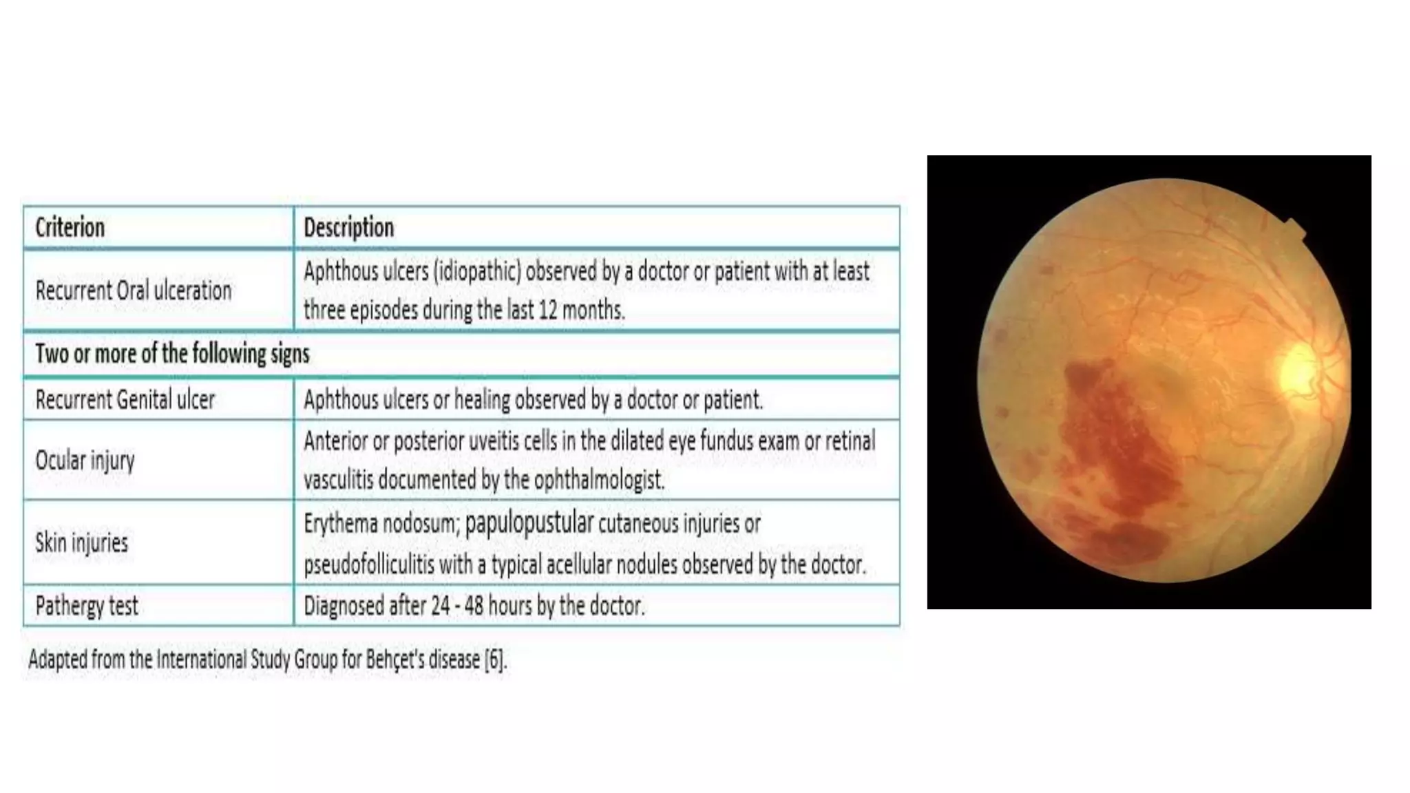 Retinal Vasculitis | PPTX
