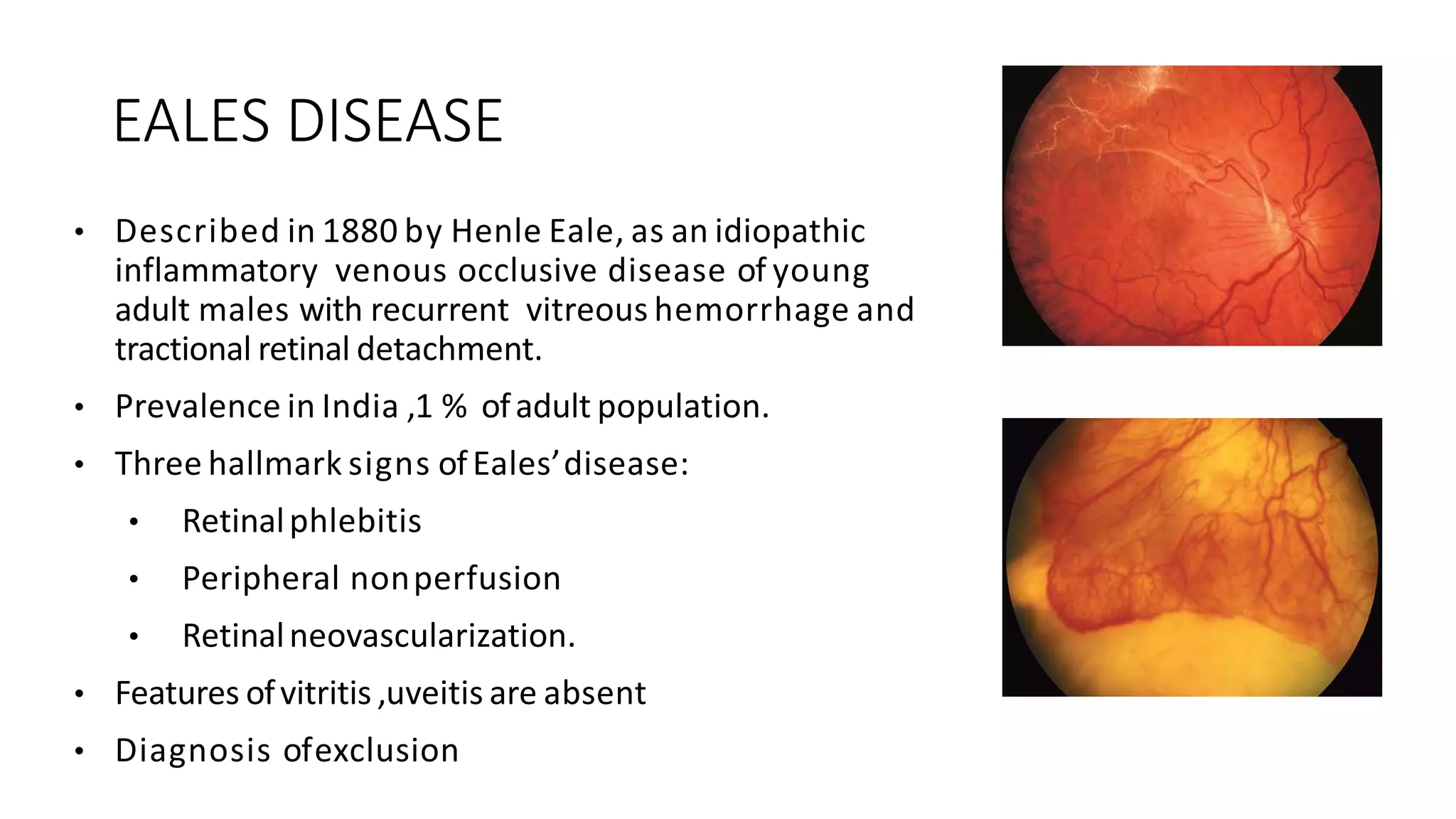 Retinal Vasculitis | PPTX