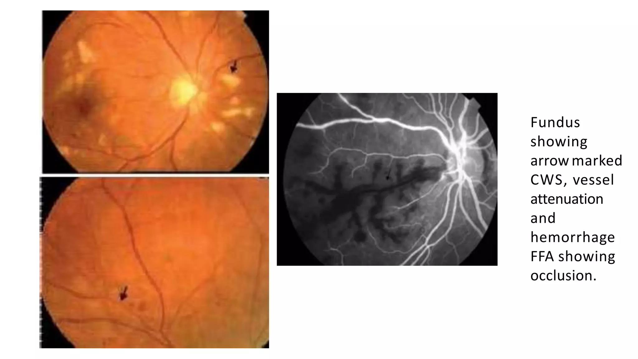 Retinal Vasculitis | PPTX