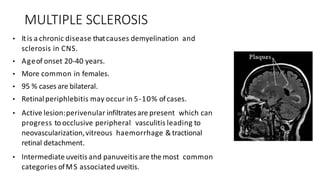 Retinal Vasculitis | PPTX