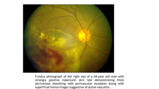 Old Retinal Vasculitis