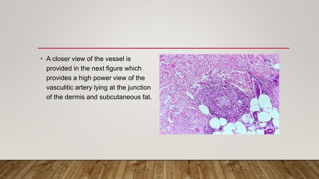 Vasculitis | PPTX