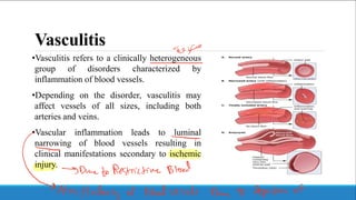 Vasculitis.pdf
