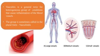 Vasculitis.pptx