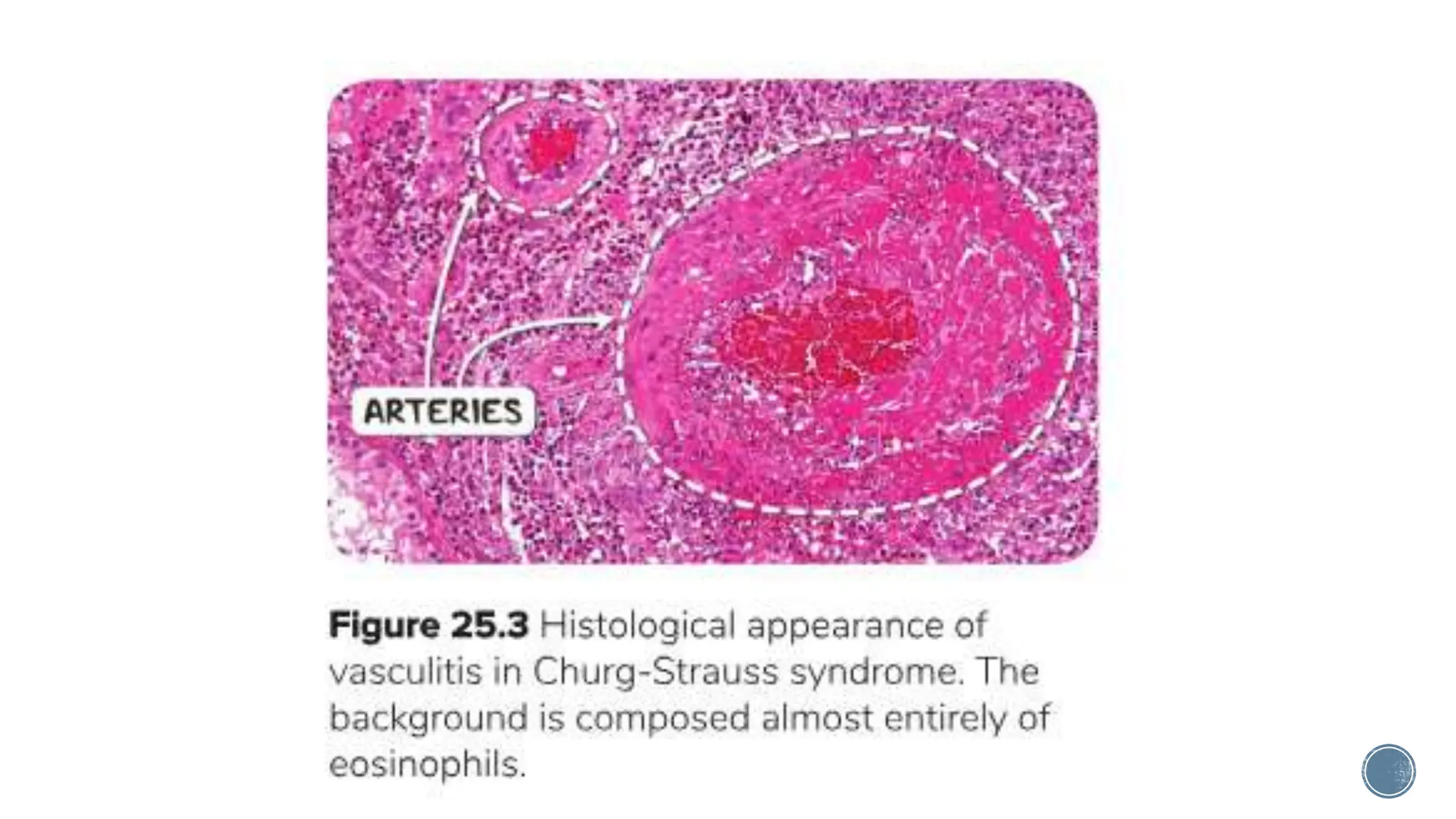 VASCULITIS.pptx | Free Download