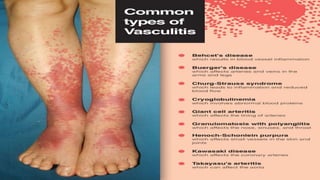 VASCULITIS.pptx