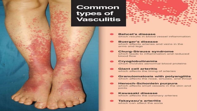 VASCULITIS.pptx