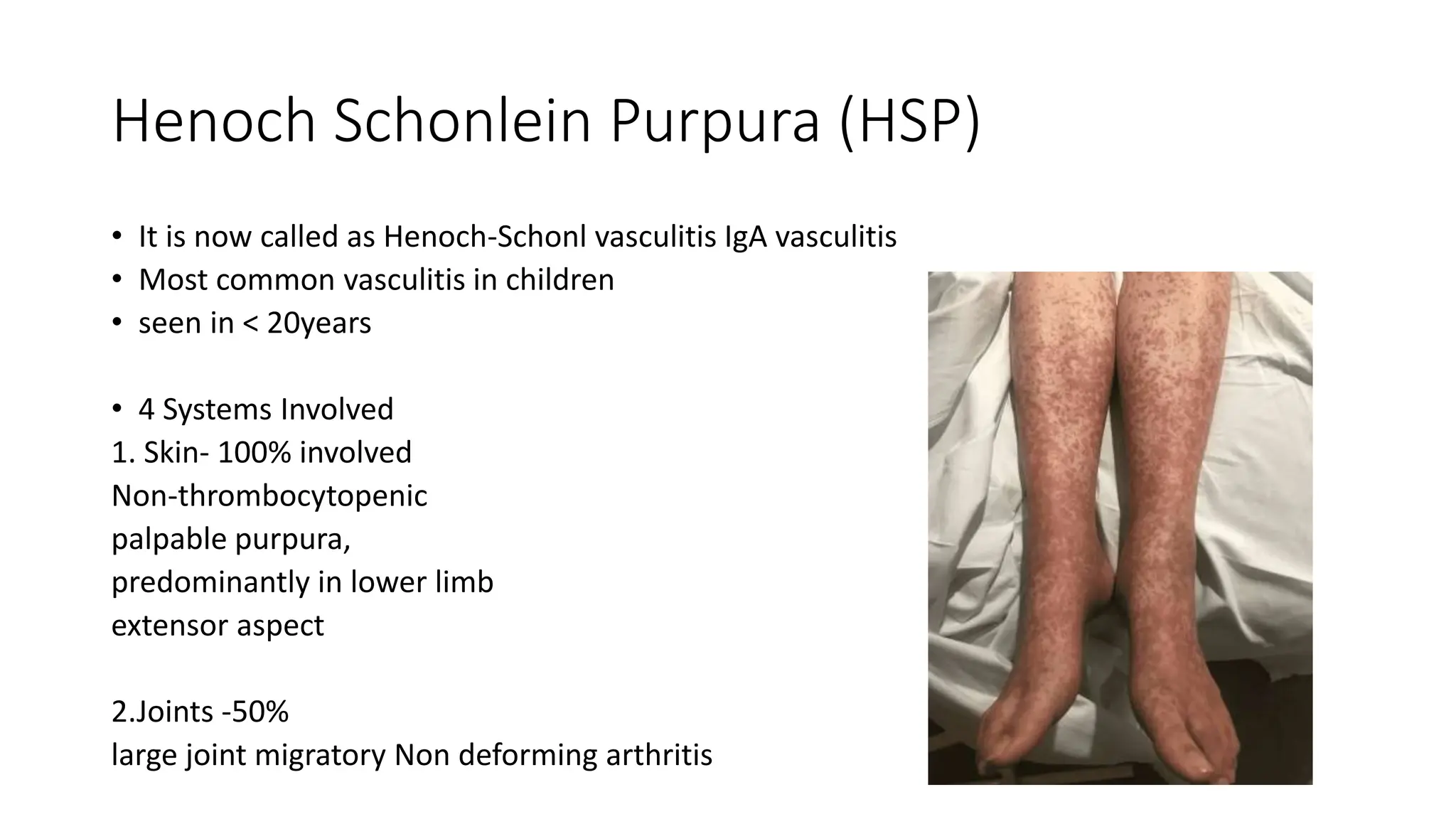 vasculitis syndromes in rheumatology.pptx
