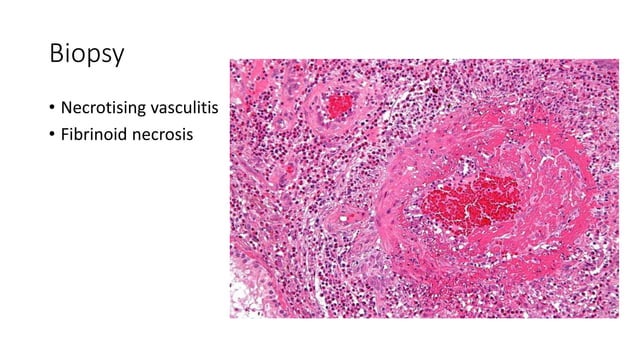 vasculitis syndromes in rheumatology.pptx
