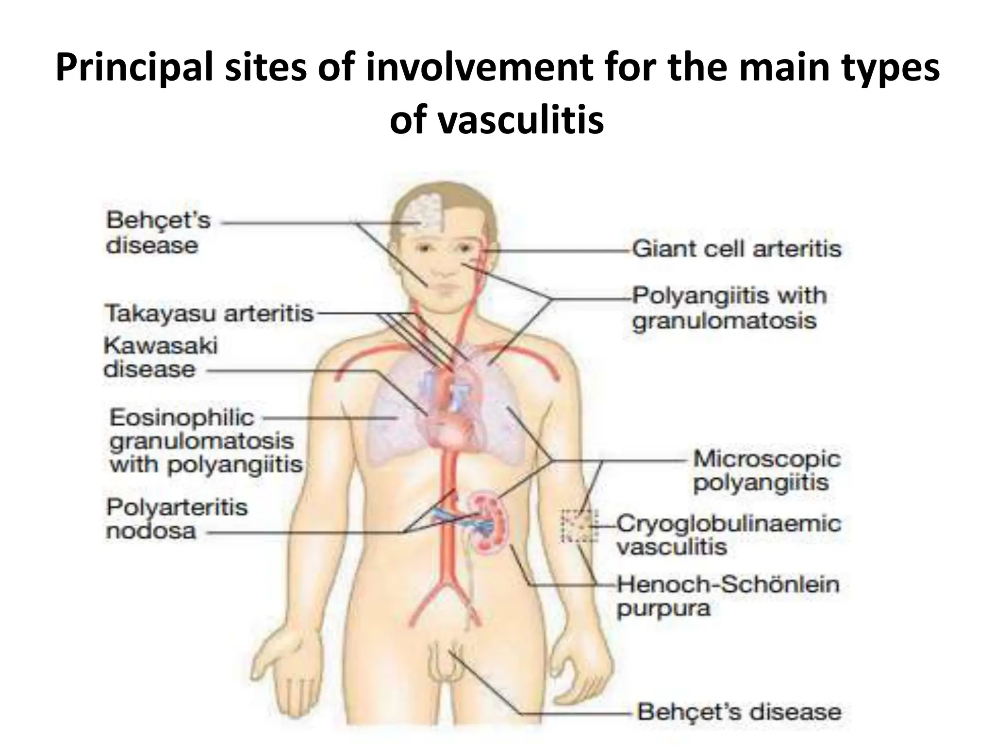 Vasculitis- Small, medium, large vessel vasculitis.pptx