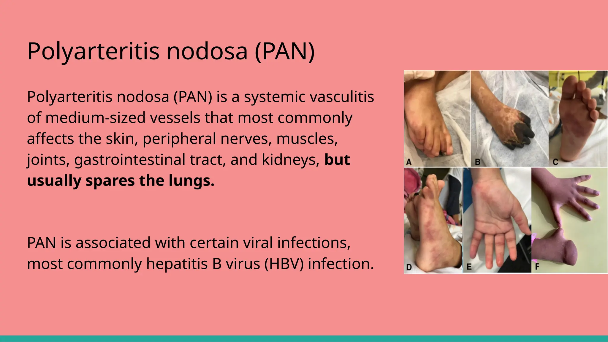 systemic vasculitis the presentation.pptx