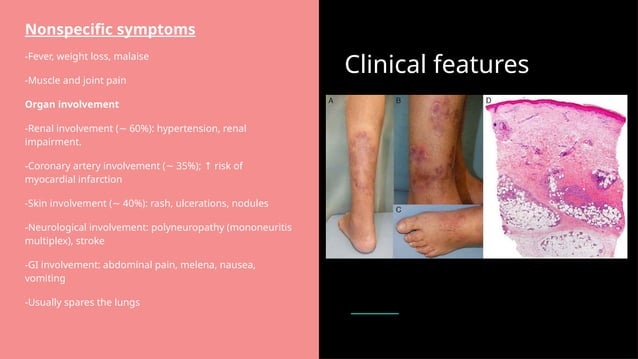 systemic vasculitis the presentation.pptx