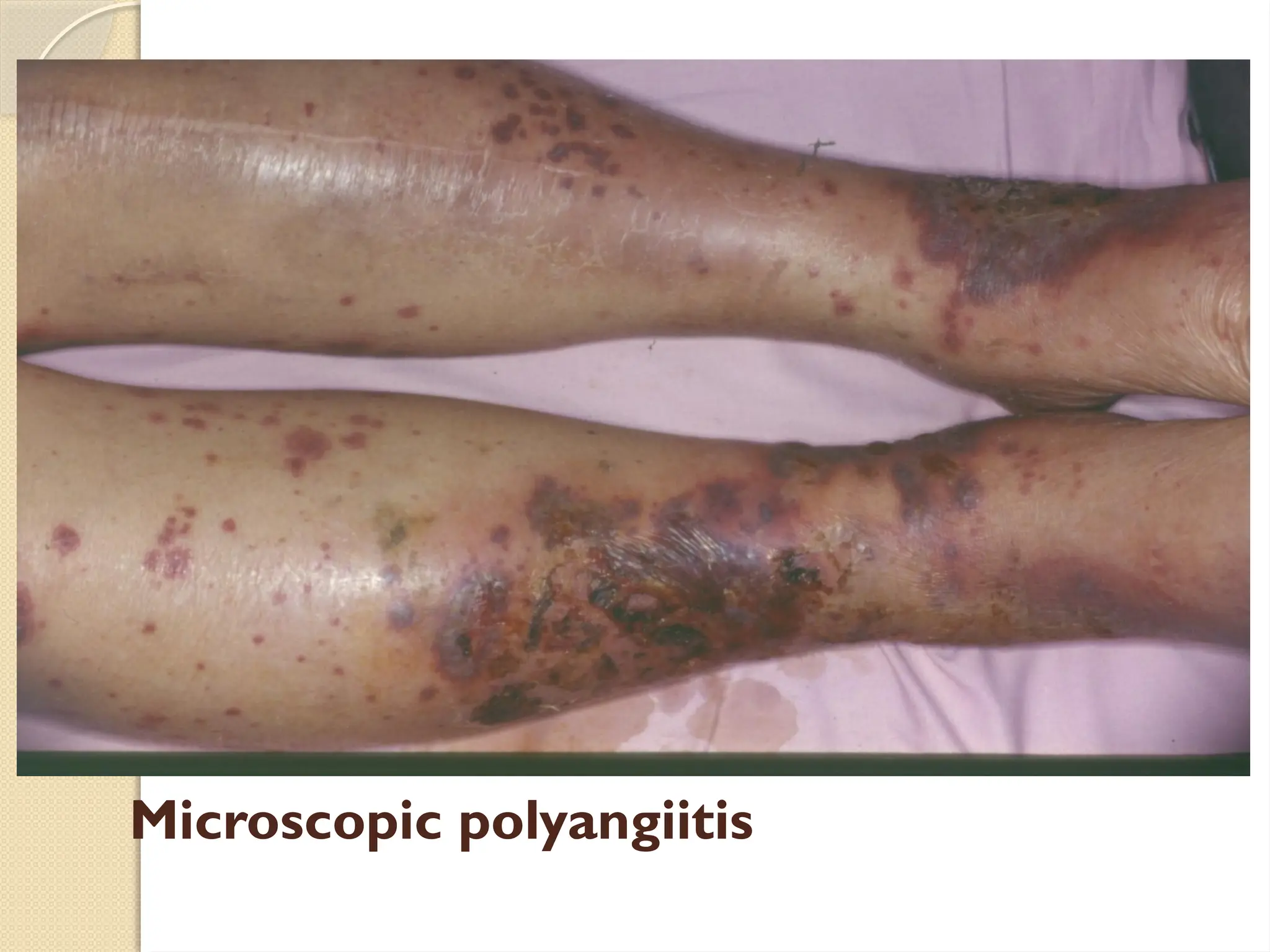 VASCULITIS.pptx different types of vasculitis | PPTX