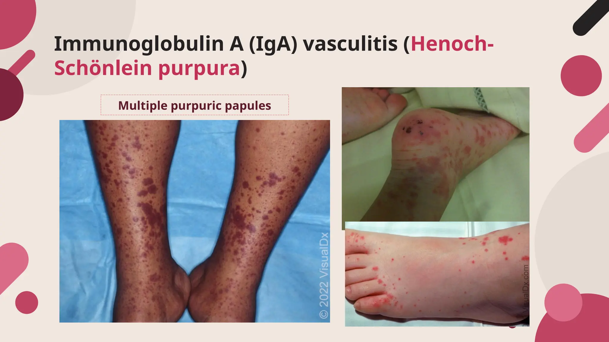 Vasculitis Definition and Classification | PPTX