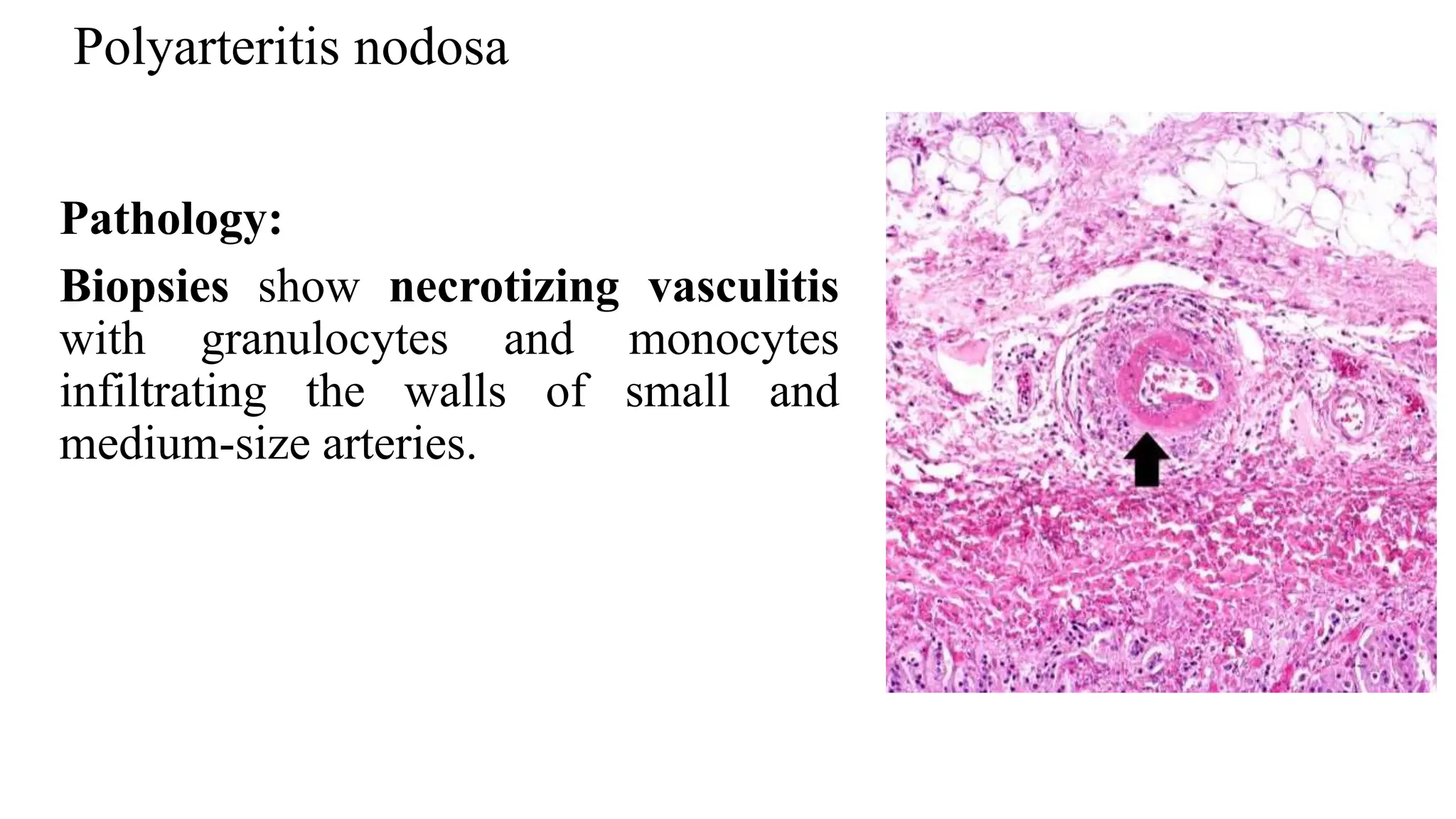 Childhood Vasculitis pathology & Pathogenesis | PPT