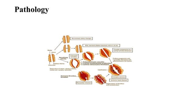 Childhood Vasculitis pathology & Pathogenesis | PPT