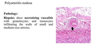 Childhood Vasculitis pathology & Pathogenesis | PPTX
