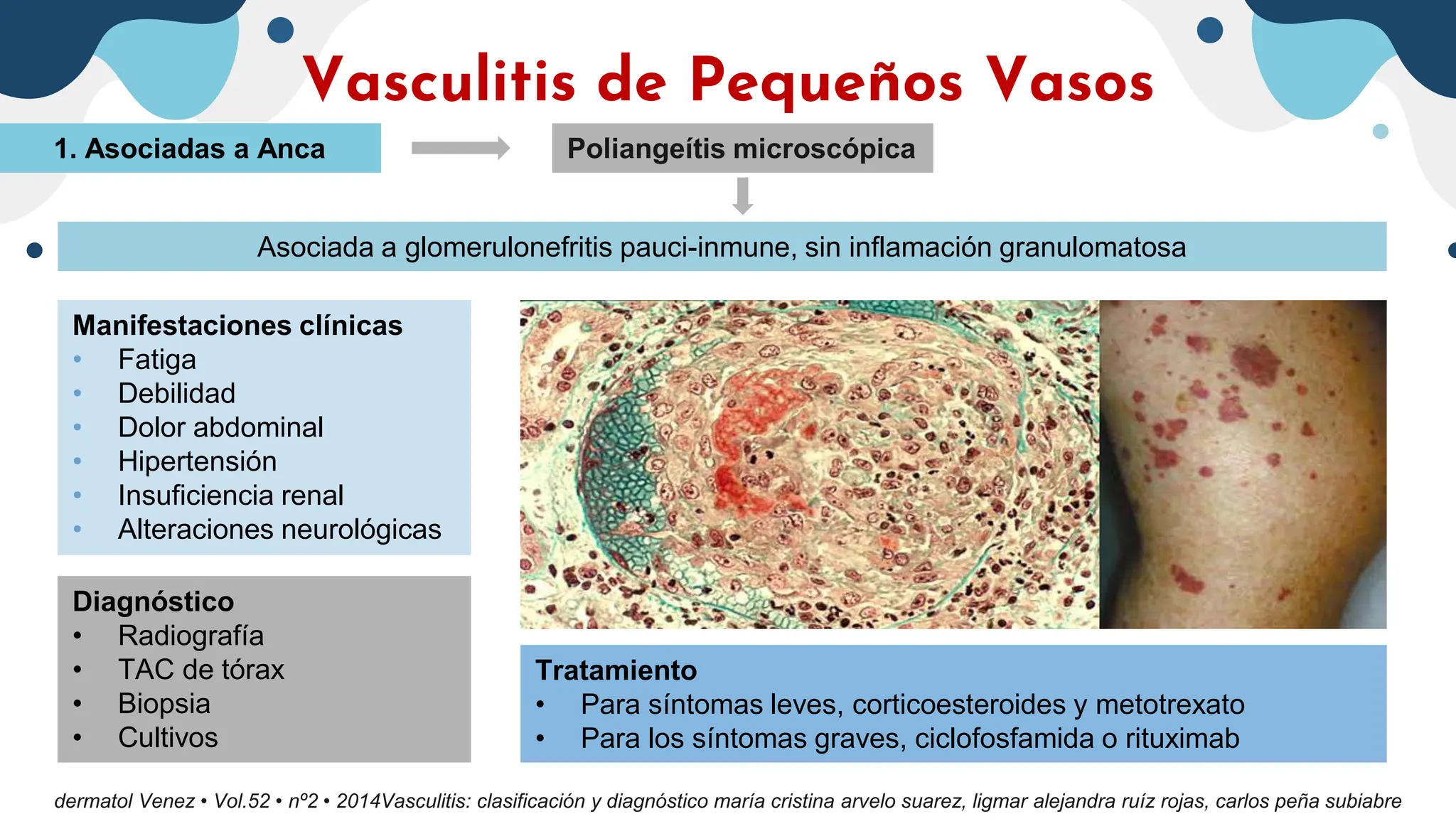 vasculitis. Síndromes vasculiticos, etiologías | PPTX