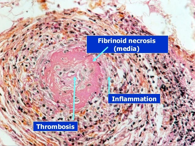 Vasculitis 2015 undergraduate