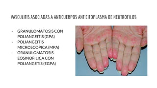 VASCULITIS ASOCIADA AL ANCA.pptx