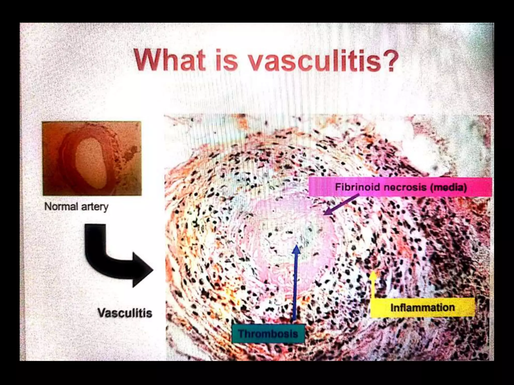 Vasculitis -an approach | PPTX