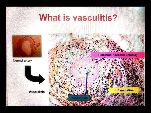 Vasculitis -an approach | PPT